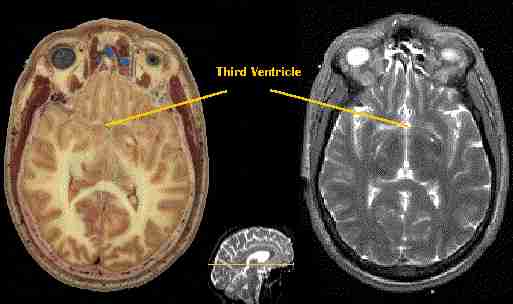 Third Ventricle Mri