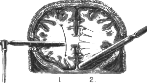 Sabbatini, R.M.E.: The History of Lobotomy